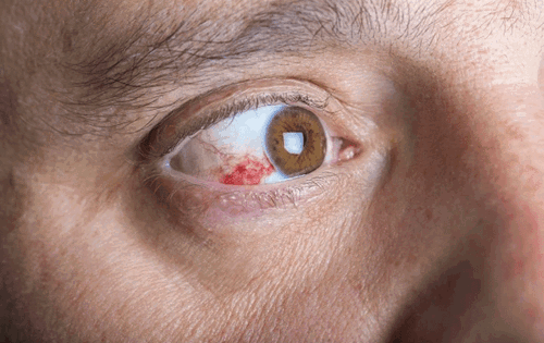 Why do I have a constant sticky eye and what is the cure?