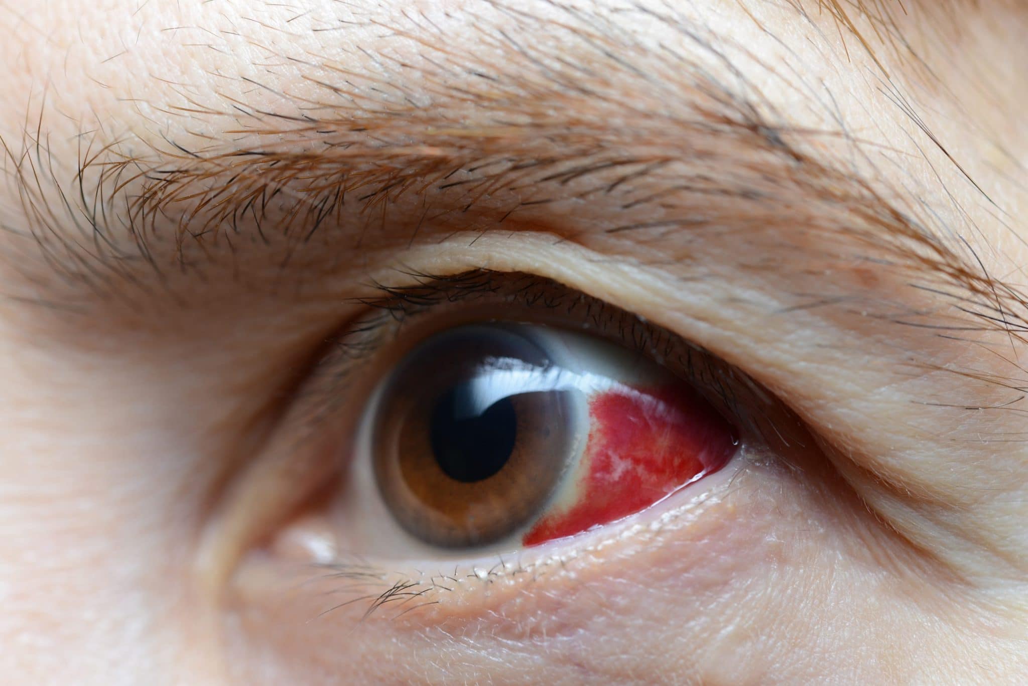 Red Eye 4 Top Reasons Why The White Of Your Eyes Are Red