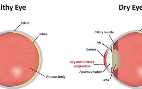 Dry Eye Definition: Are Your Eyes Not Making Enough Tears?