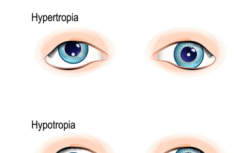 The prescription between both my eyes is vastly different
