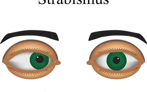 Why am I Seeing Squiggles (Floaters) in my Vision?