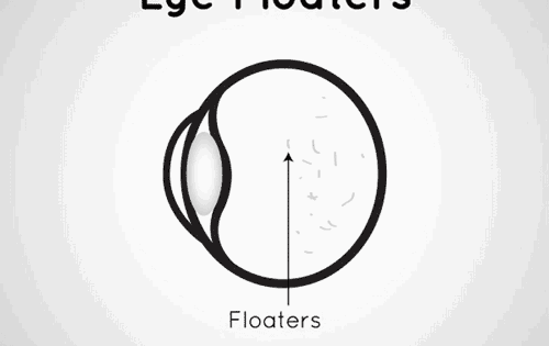 Eye Floaters Definition: What are Eye Floaters?