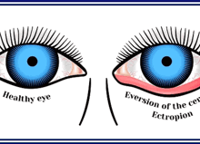 Causes of droopy eyes & eyelids | Book An Eye Test