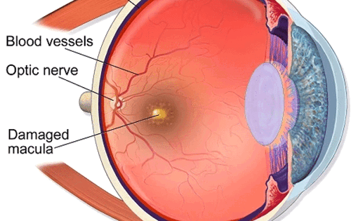 My Vision Appears To Be Distorted (Gradual Deterioration)