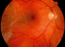 What is a corneal ulcer and how to treat it? | Book An Eye Test